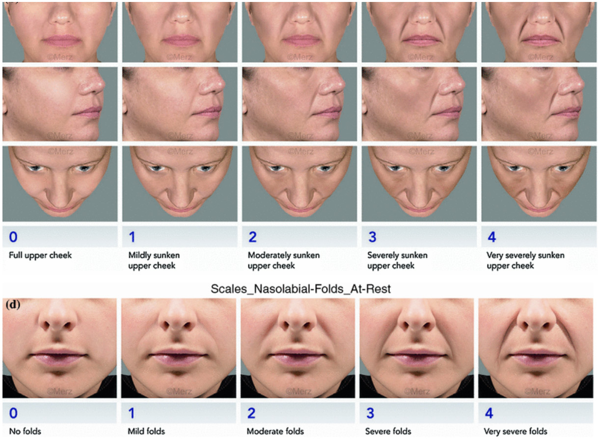 法令紋拉提怎麼選？電音波、洢蓮絲、4D童妍針、玻尿酸全解析 | 三豐診所